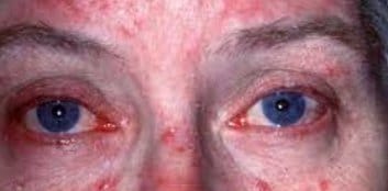 Blepharitis Symptoms Causes & Cures - The Ultimate Guide To Blepharitis